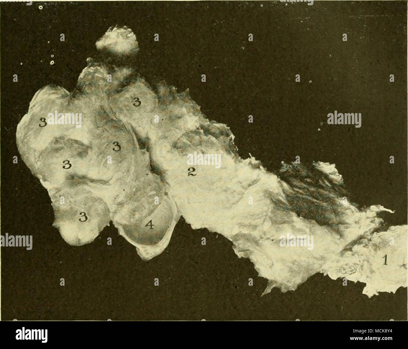 . Fig. 163—Complete Pelvic Adhesions with Uterus, Cornua, Oviducts, and ...