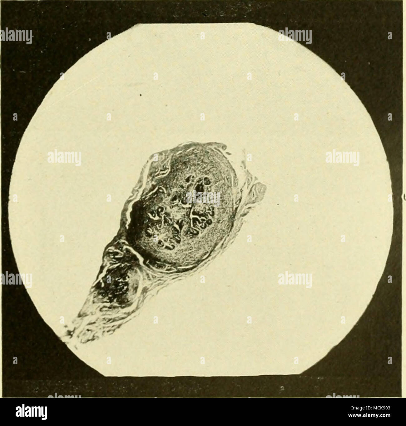 . Fig. 148—Chronic Catarrhal Salpingitis. With Well Advanced Occlusion ...