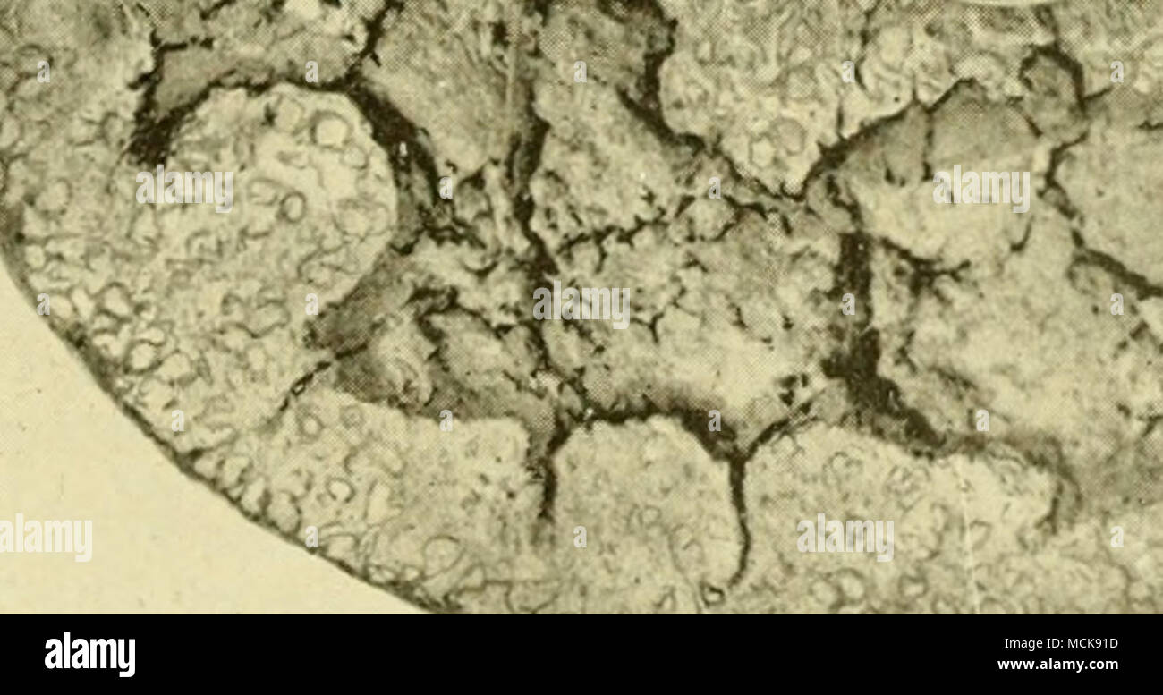 . Fjg. 109—Advanced Tubo-Uterine Tuberculosis, with Necrosis of Mucosa ...