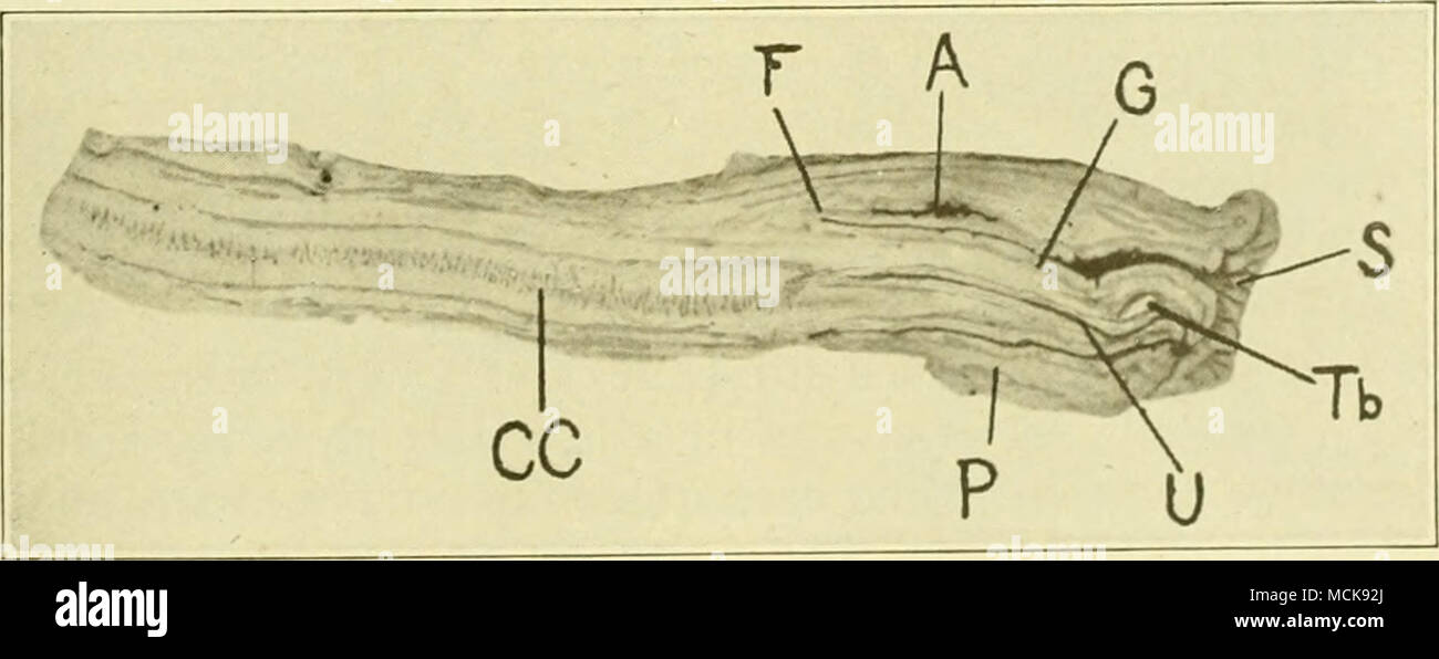 . pIG- 95—Tuberculosis of Glans and Prepuce. G, Glans ; P, prepuce ; F ...