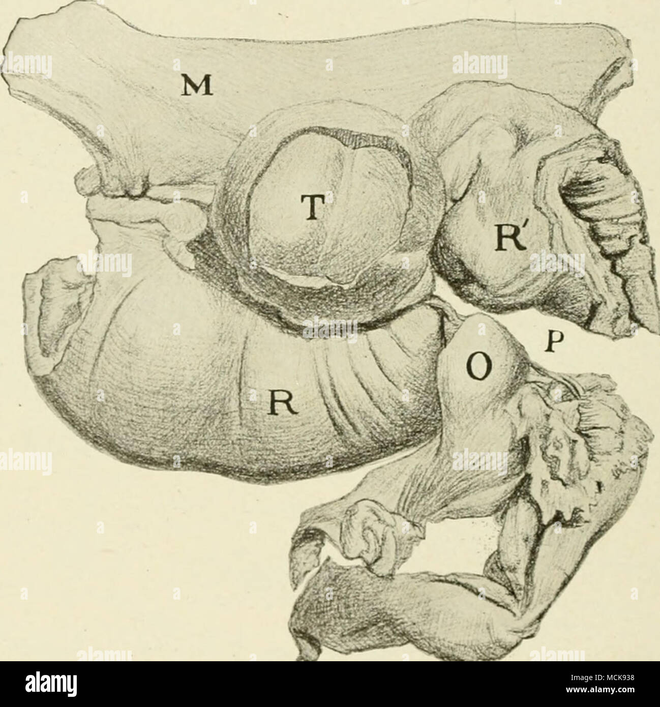 . Fig 73—View of Fig. 72 from left side, the tumor exposed l>y cutting ...