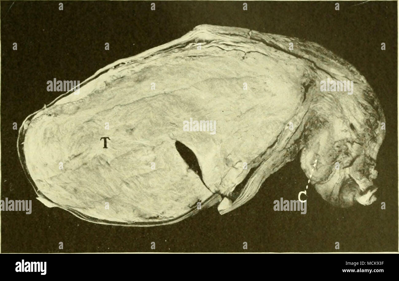 . Fig. 77—"Uterine Fibroid. Cow. C, Cervix ; T, Tumor Stock Photo - Alamy