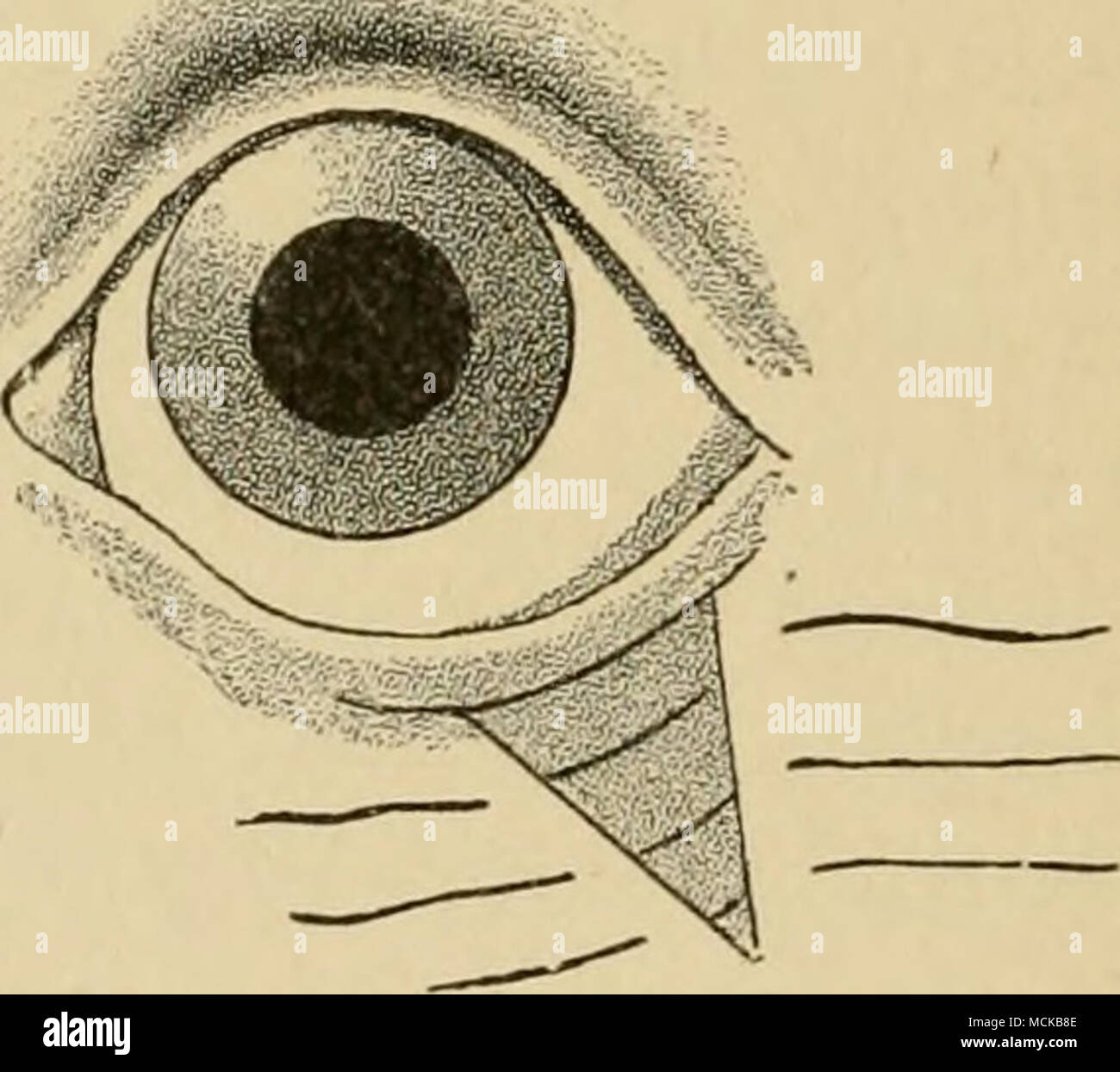. Operation for entropion by means of excision : a, elliptical incision ...