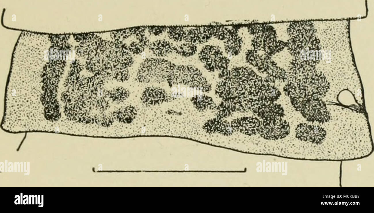 Enlarged colon hi-res stock photography and images - Alamy
