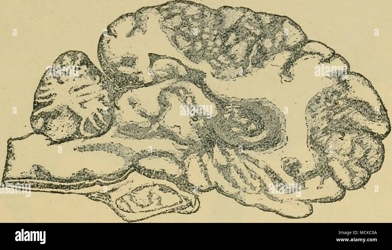 . Fig. 281.—Tuberculosis of the brain. 1, 2 and 3, Tuberculous centres ...