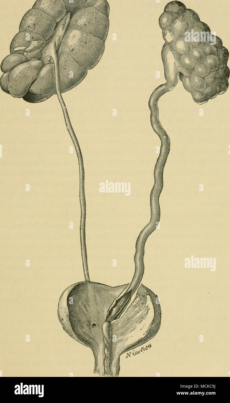 . Fig. 230.—Pyelo-neplu-itis with hsemorrhagic pyo-iiephrosis of one ...