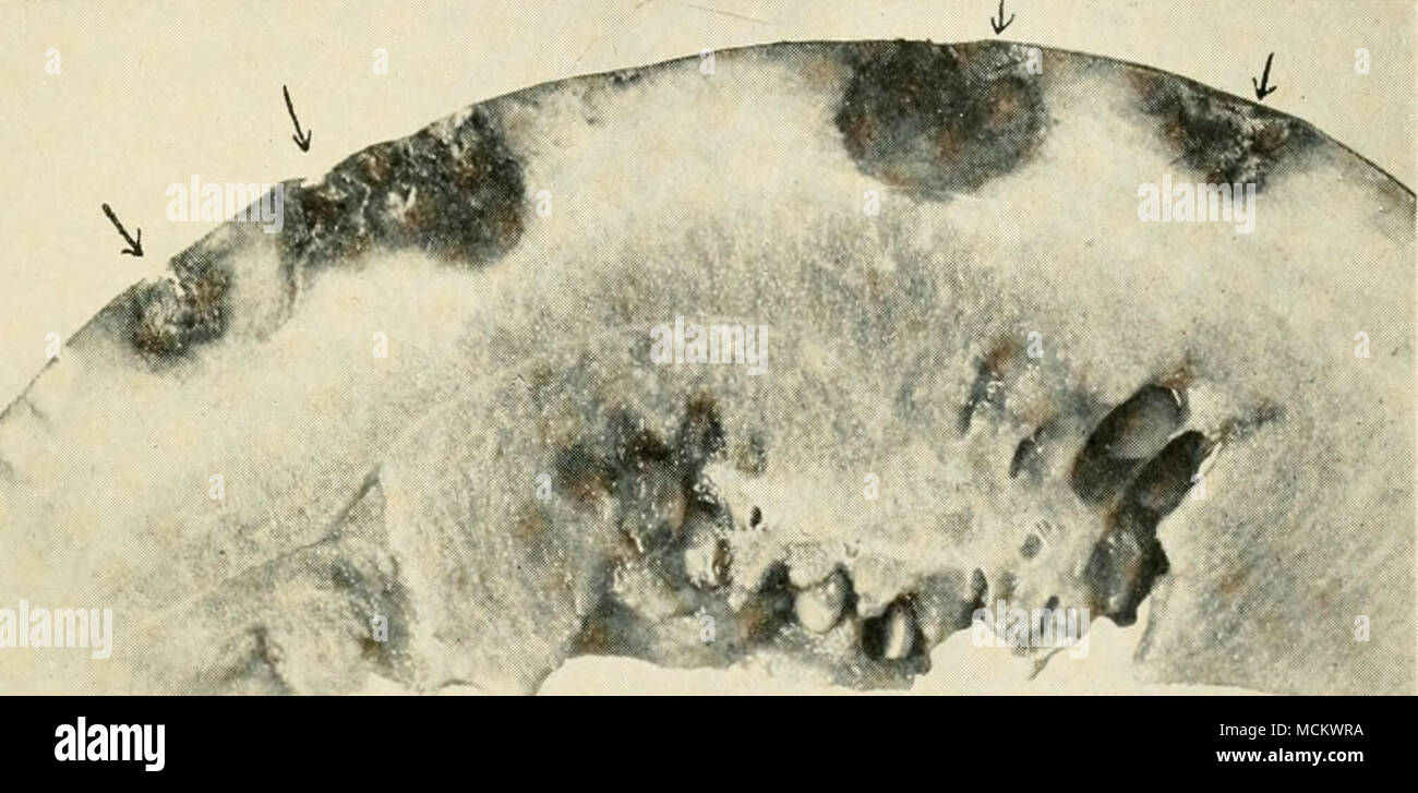 . Fig. II. Watermelon Slice Showing Hail Injury. Arrows In- dicate ...