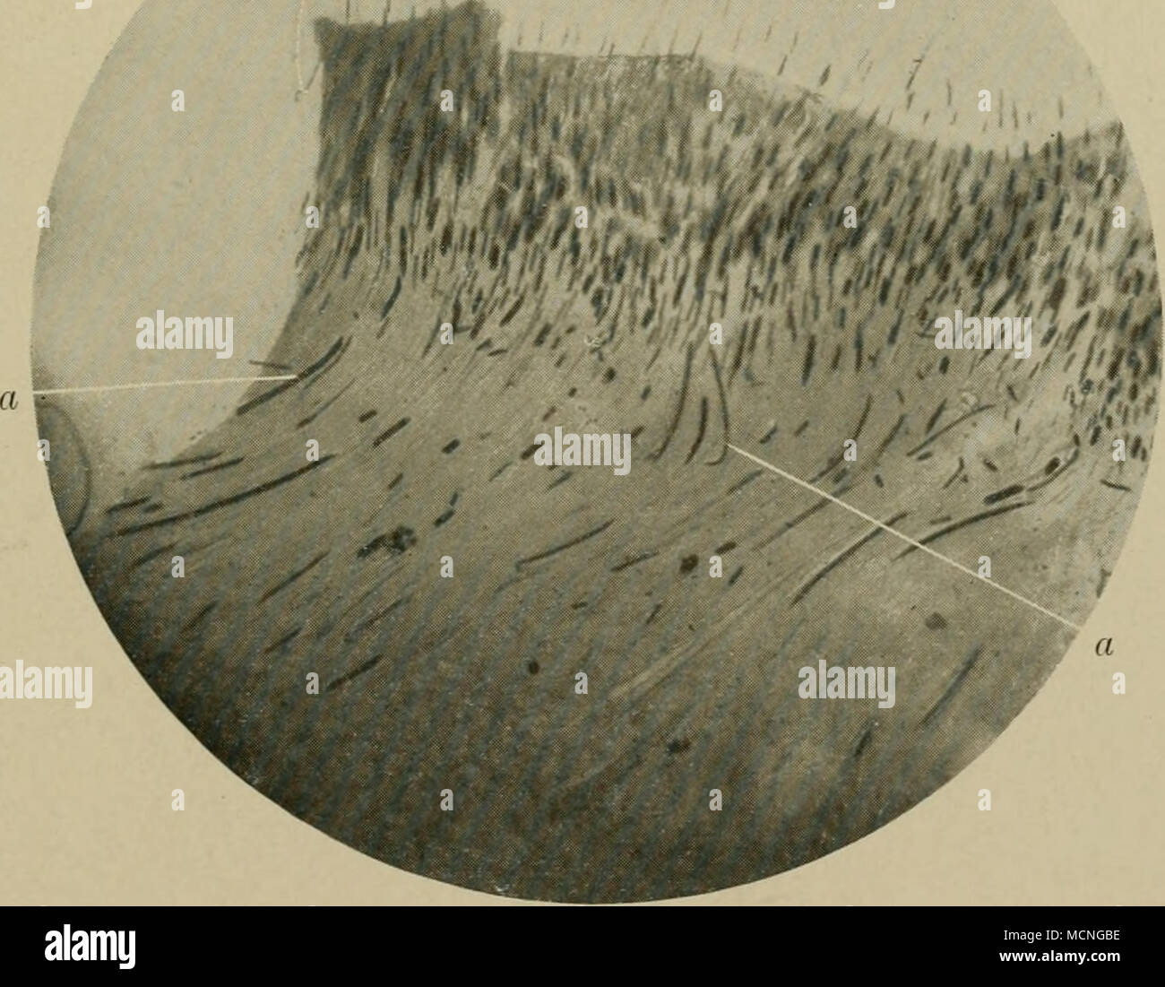 . Kalb. Ichthyosis congenita, n Abnorme Richtung des Haarwachstums. Das ...