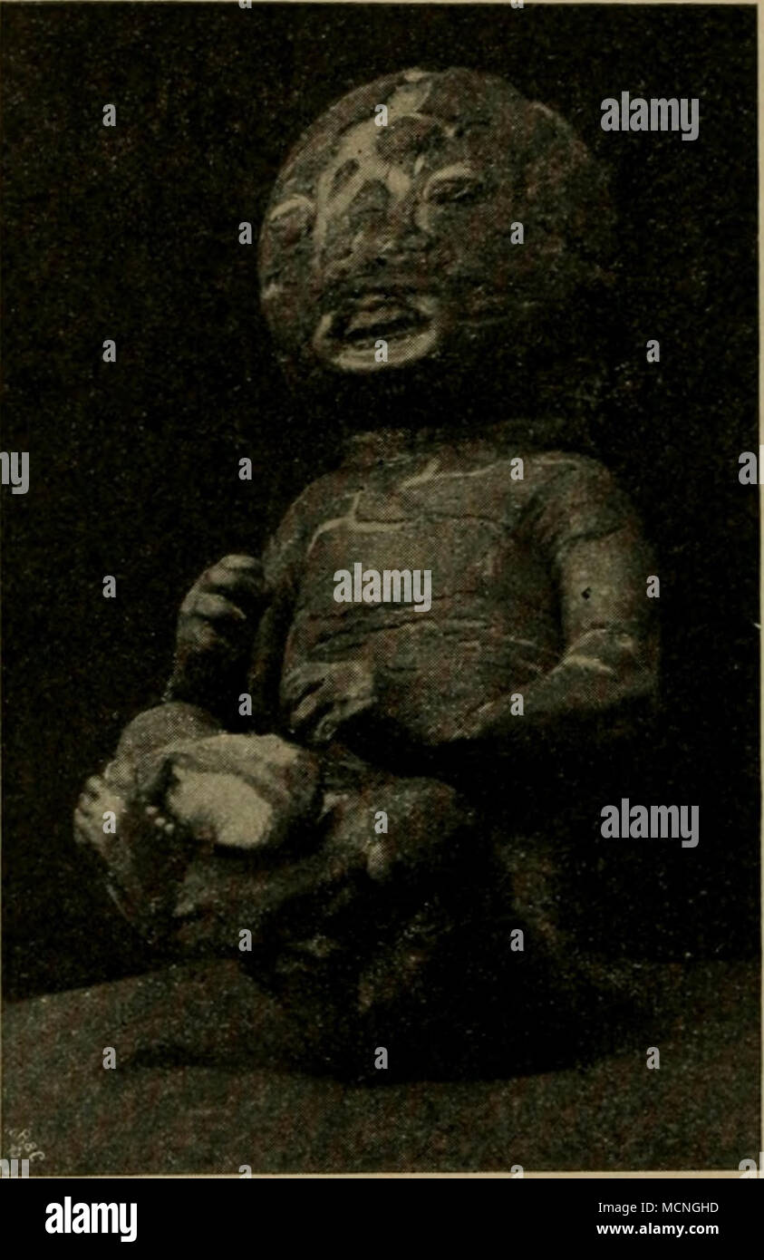 . Ichthyosis congenita. (Patholog. Institut der Universität Berlin ...