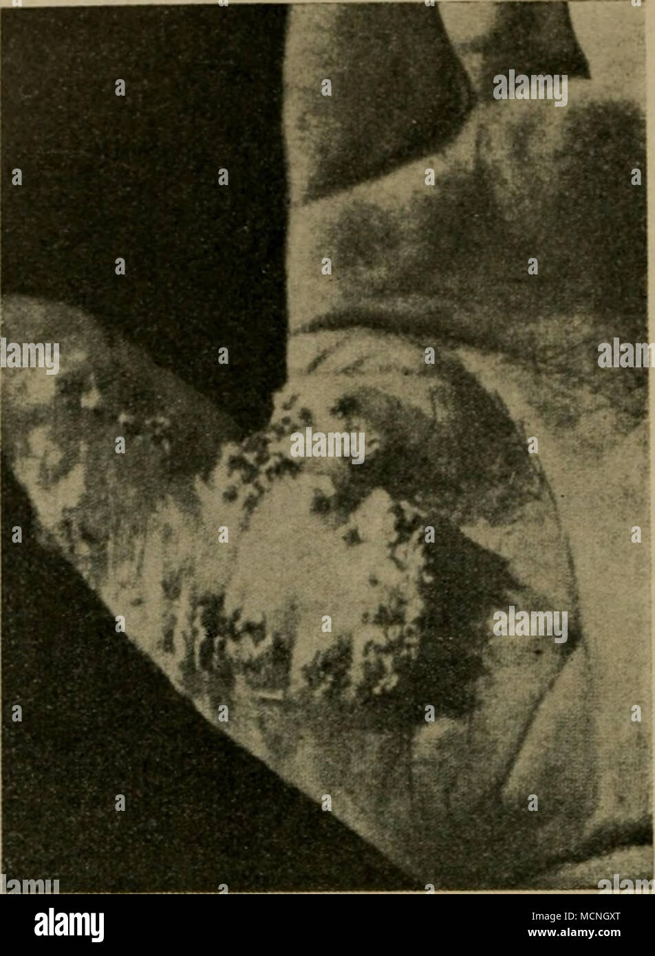 . Tuberculosis cutis verrucosa der Hand; durch Autoinokulation beim ...
