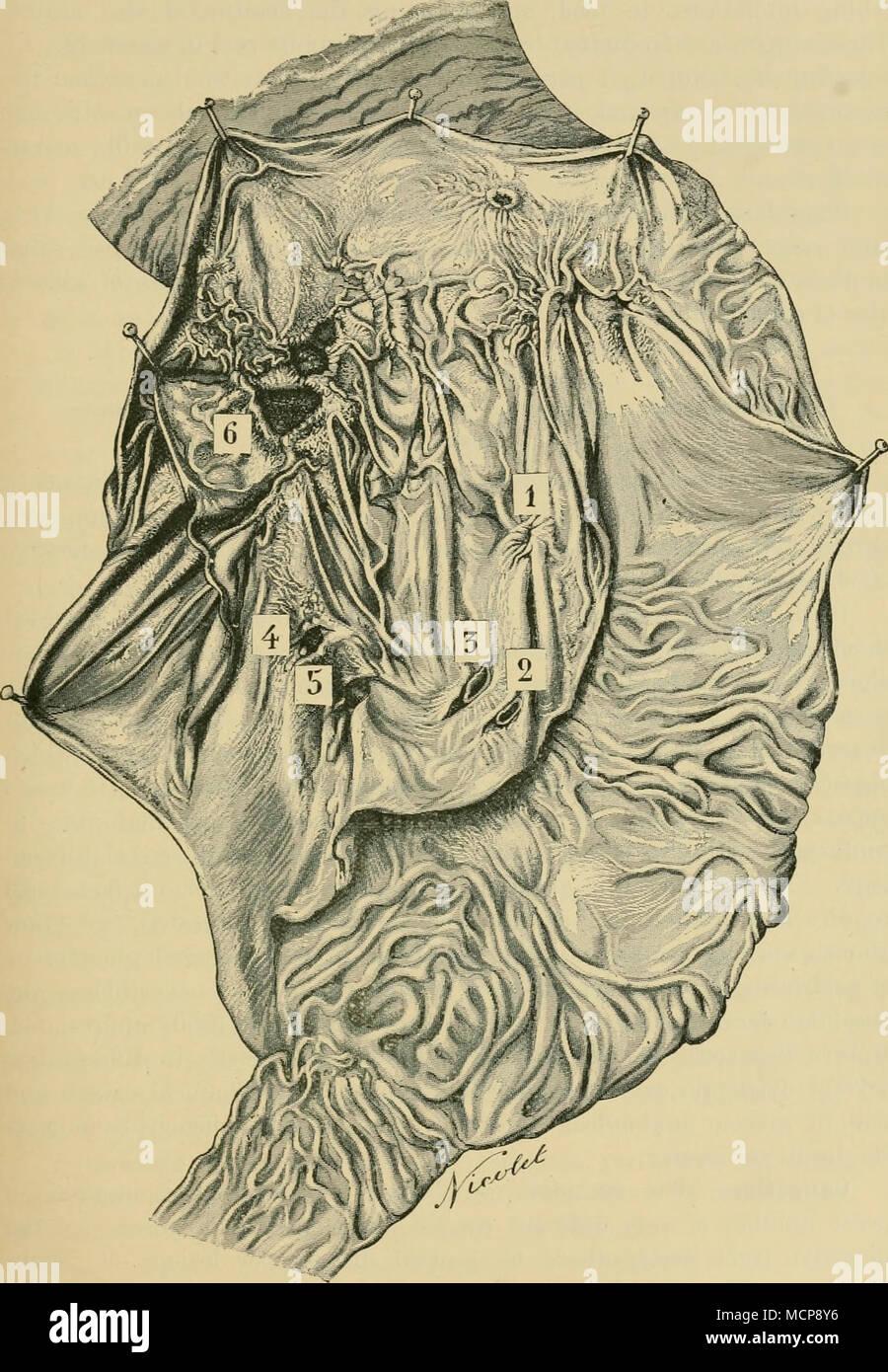 . Fig. 70.—Ulcerative gastritis. 1, Typical round ulcer; 2 and 3 ...