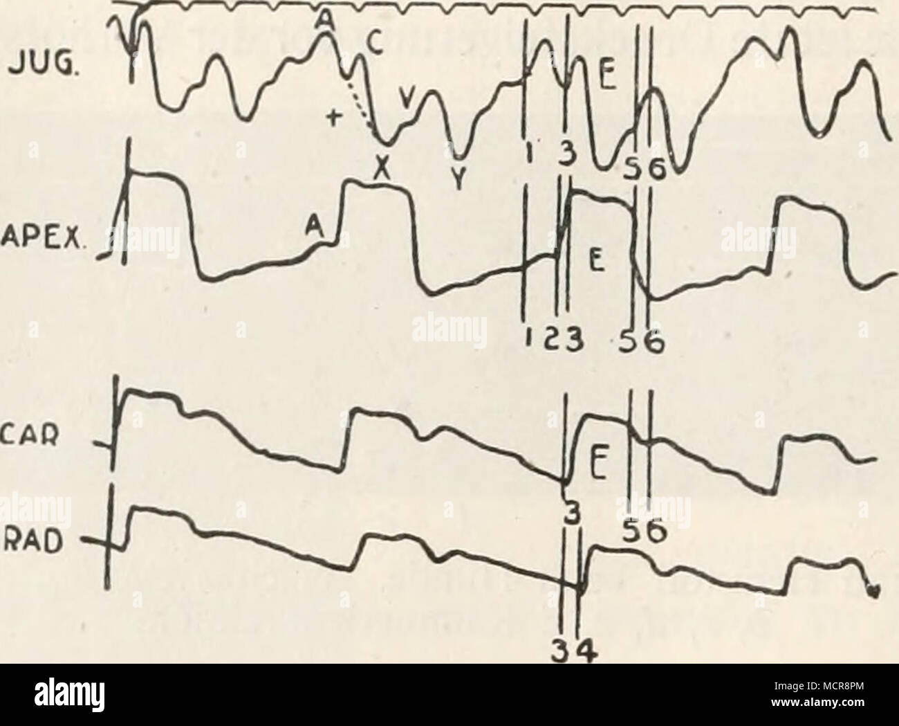 . Fig. 476. jugularispuls, Herzstoß, Carotis- und Radialispuls beim ...