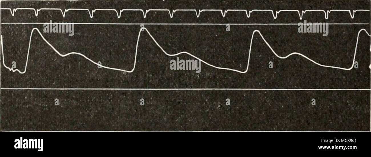 . Fig.395. Radialispuls mit dem Frank-Fetter?,Q