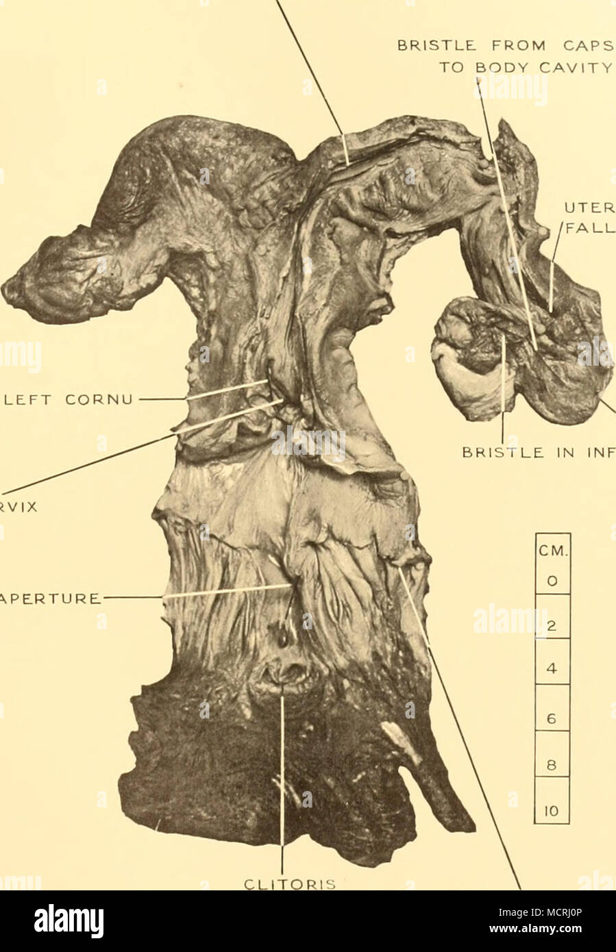 . 00 UTERINE END OF £3^ /FALLOPIAN TUBE RIGHT OVARY LE IN INFUNDIBULUM ...