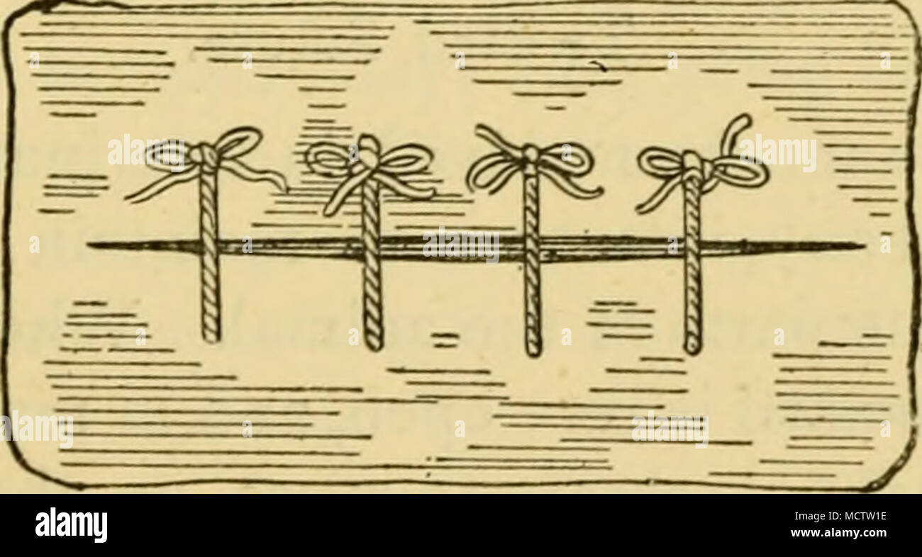 Interrupted sutures hi-res stock photography and images - Alamy