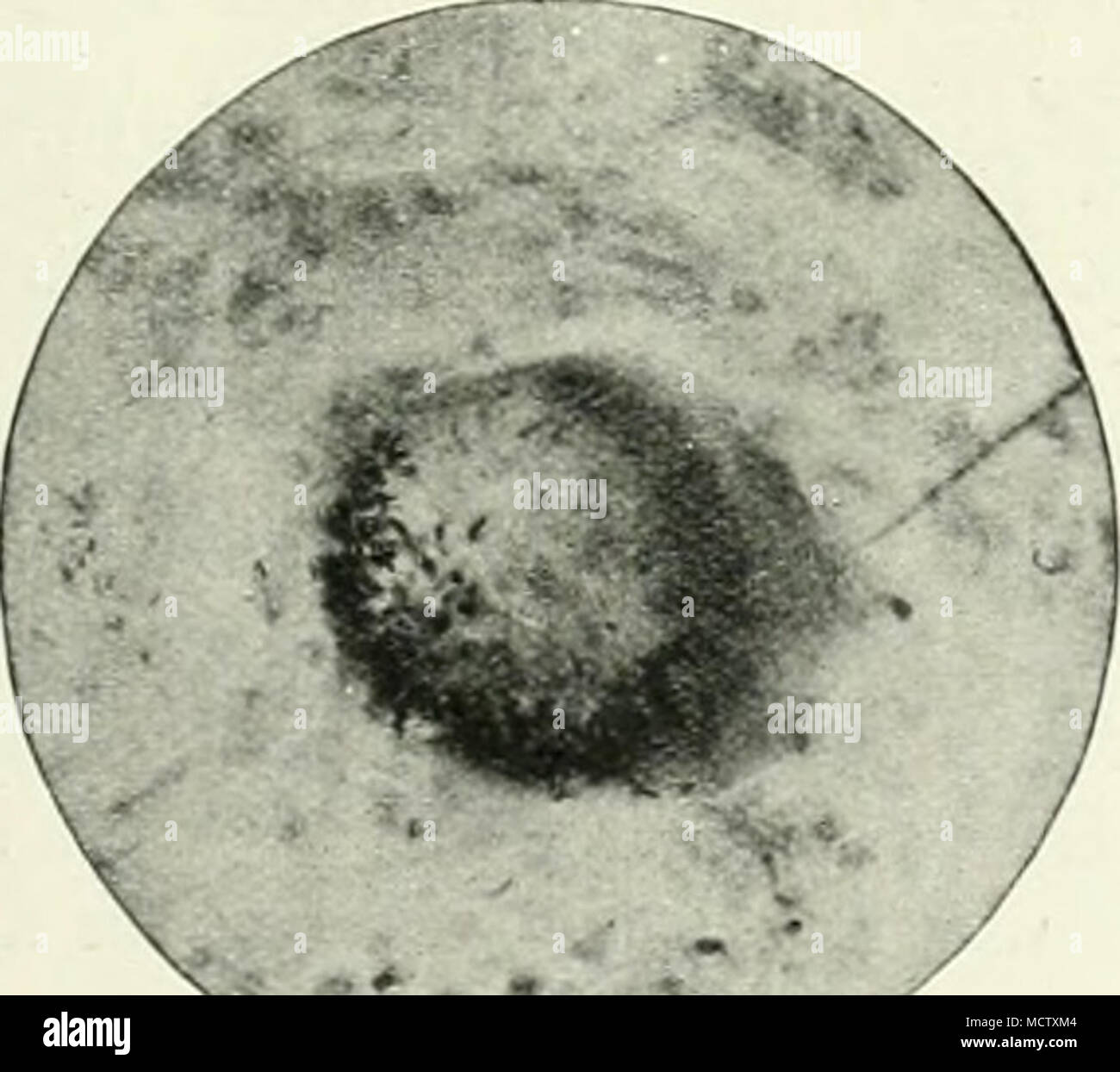 Tubercle bacillus hi-res stock photography and images - Alamy