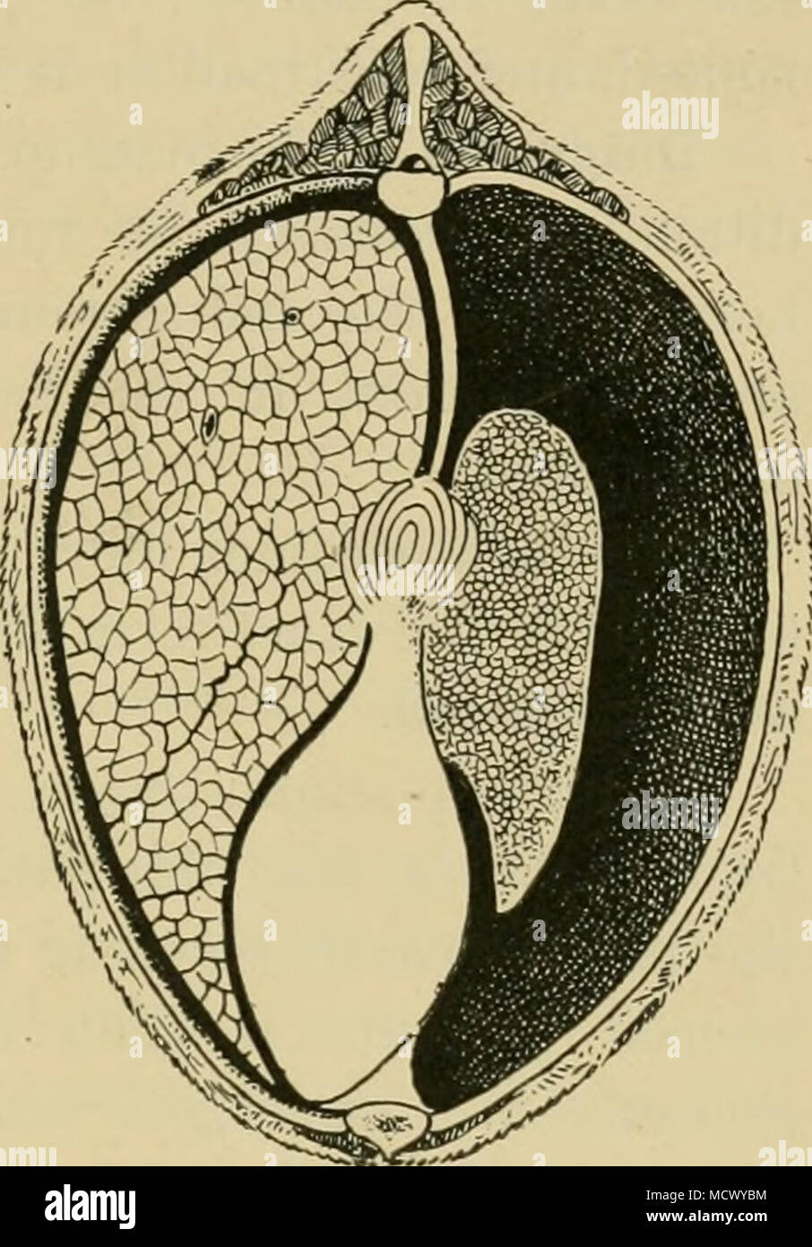 . Fig. 171.—Schema illustrating open pneumo-thorax. Eight lung col ...