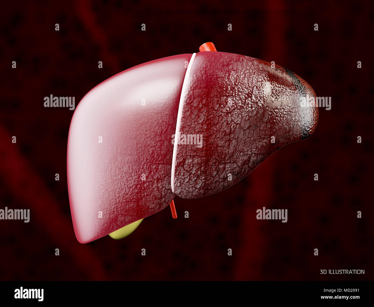 Realistic 3d illustration of comparsion of healthy and sick cirrhosis ...