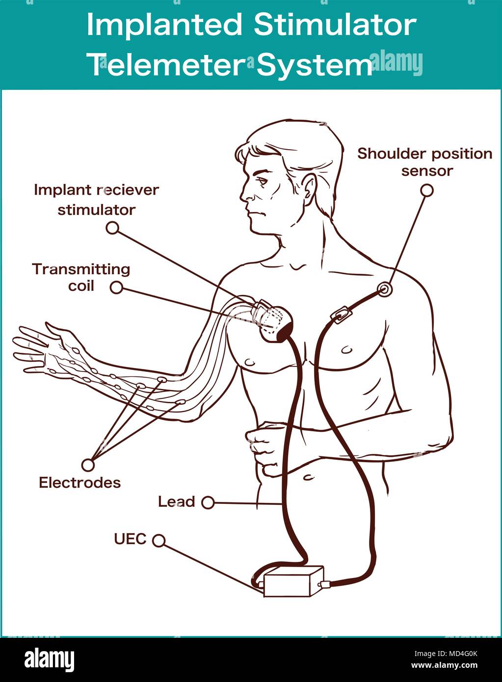 Implanted stimulator telemeter system Stock Vector Image & Art - Alamy