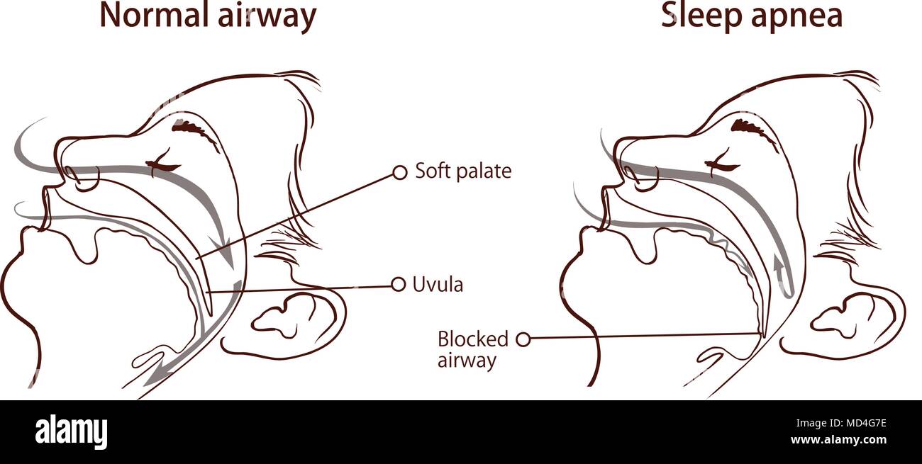 Sleep apnea and illustration hi-res stock photography and images - Alamy