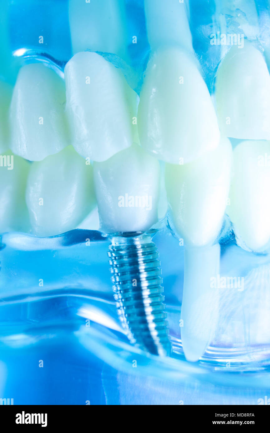 Dental titanium aesthetic orthodontic tooth implant in dentists mouth ...