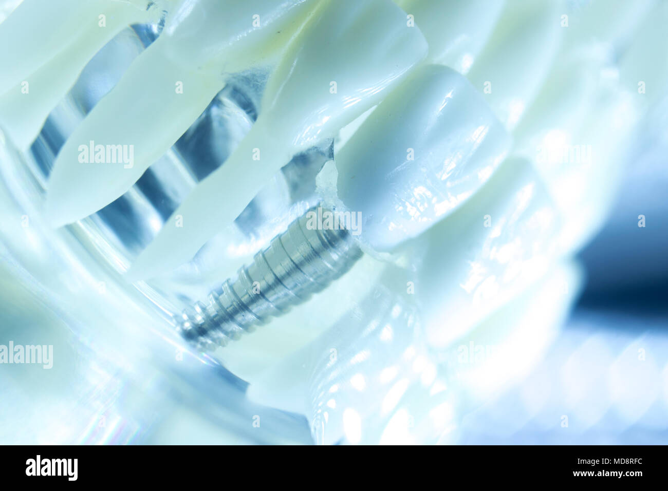 Dental titanium aesthetic orthodontic tooth implant in dentists mouth ...