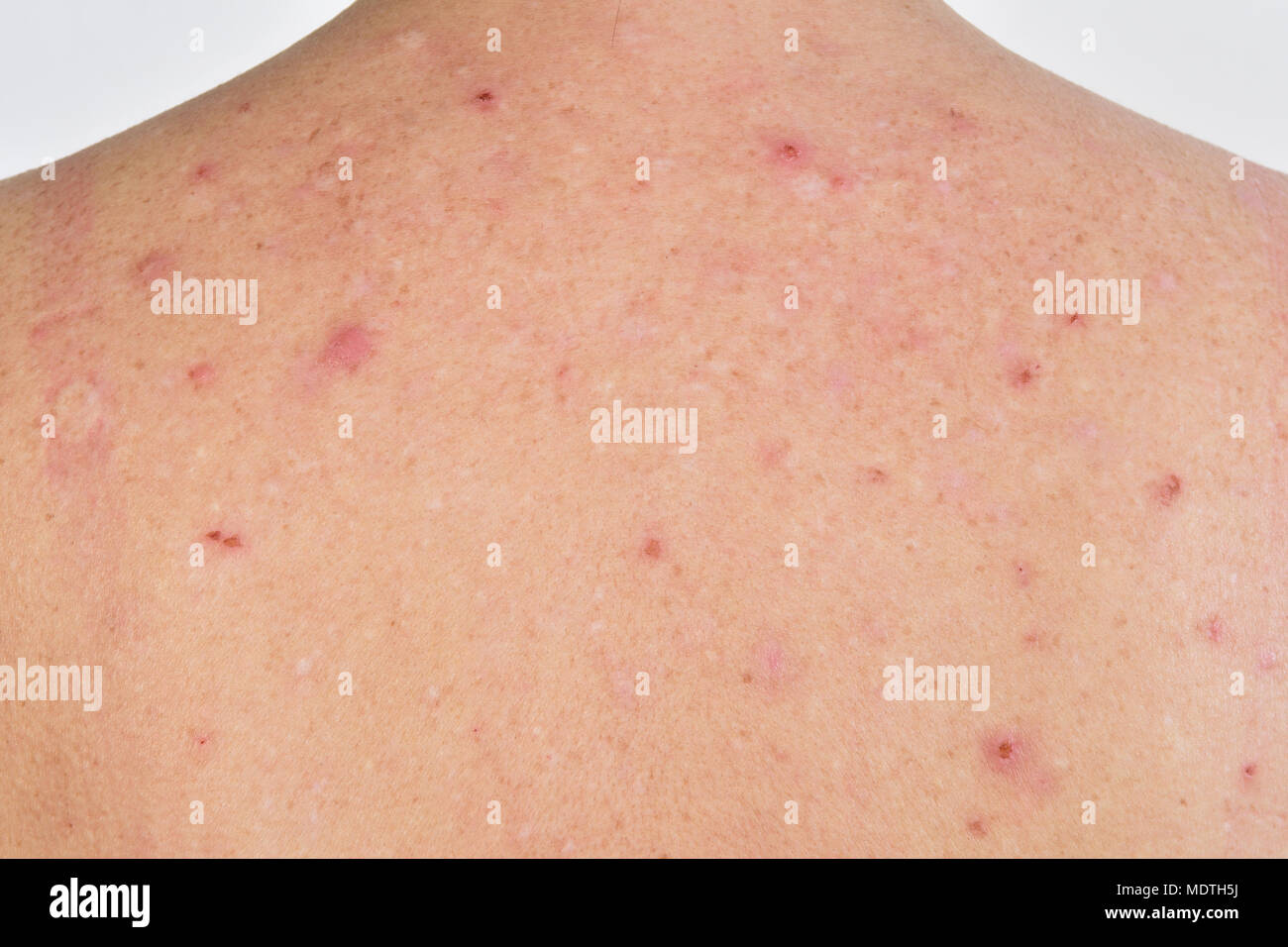 dermatitis on the back of a woman Stock Photo - Alamy