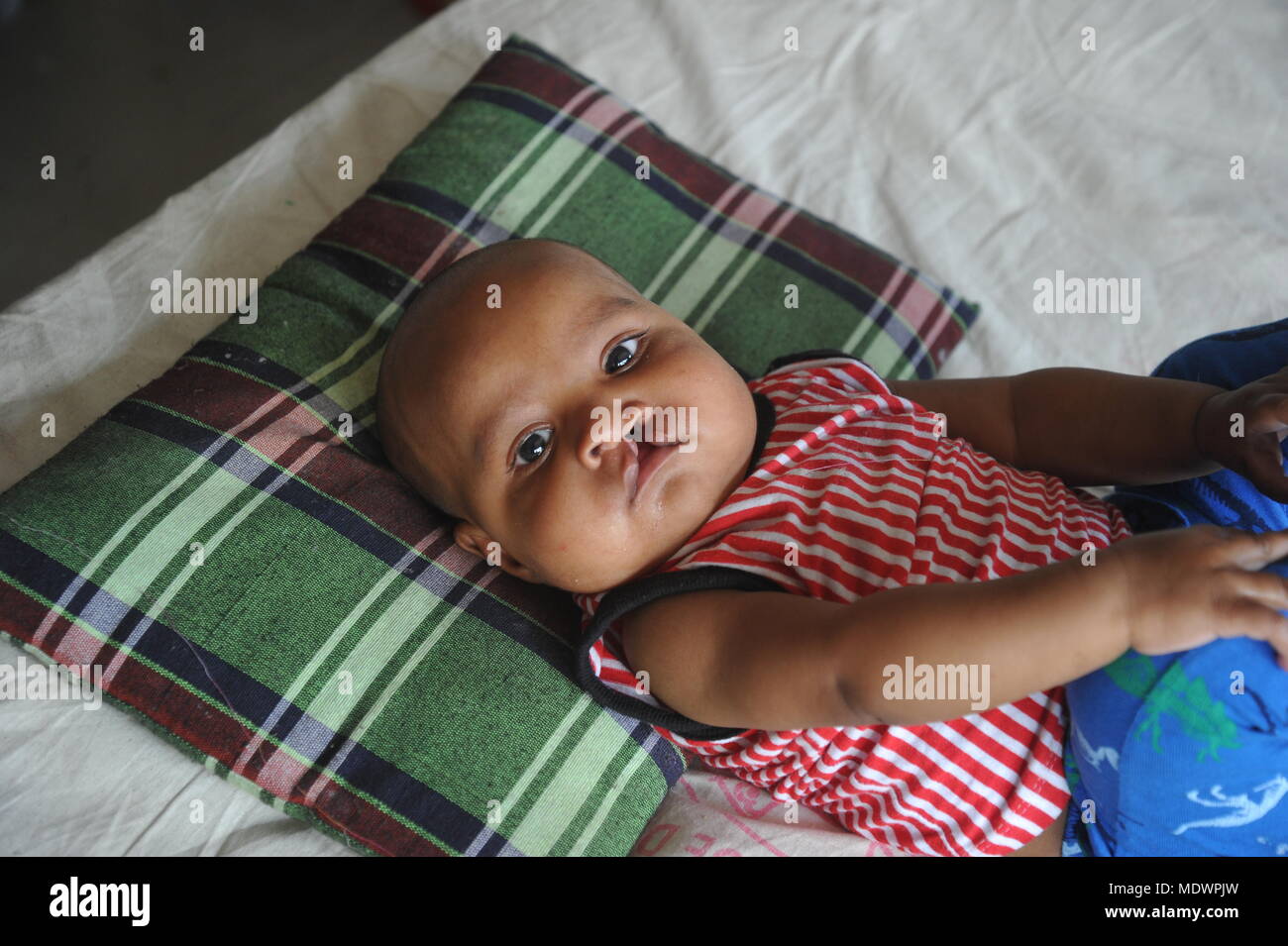 Birth defect baby boy with harelip in Dhaka medical college burn unit ...