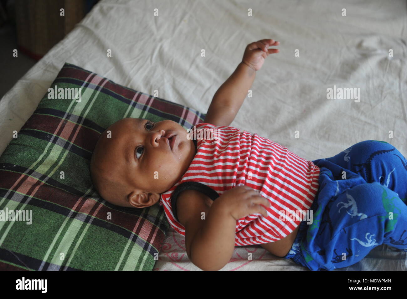 Birth defect baby boy with harelip in Dhaka medical college burn unit ...