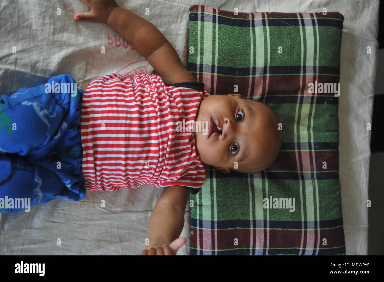 Birth defect baby boy with harelip in Dhaka medical college burn unit ...