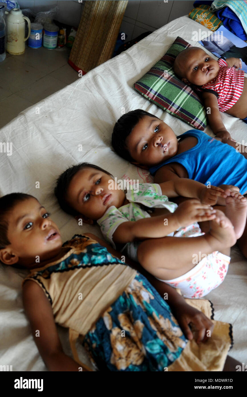 Birth defect baby boy with harelip in Dhaka medical college burn unit ...