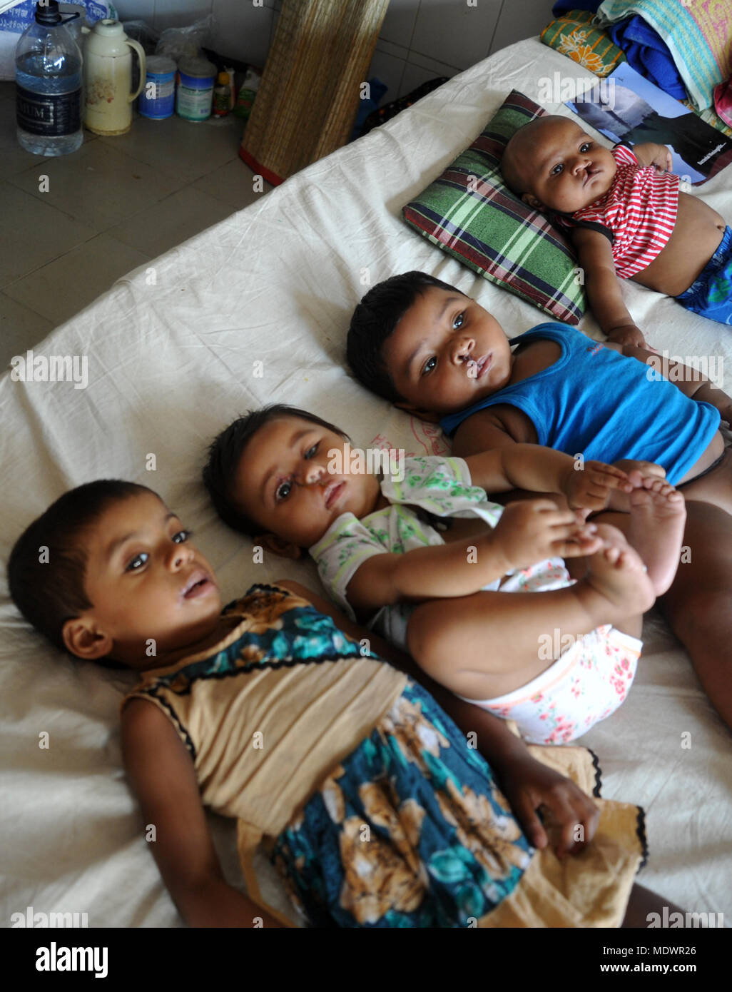 Birth defect baby boy with harelip in Dhaka medical college burn unit ...