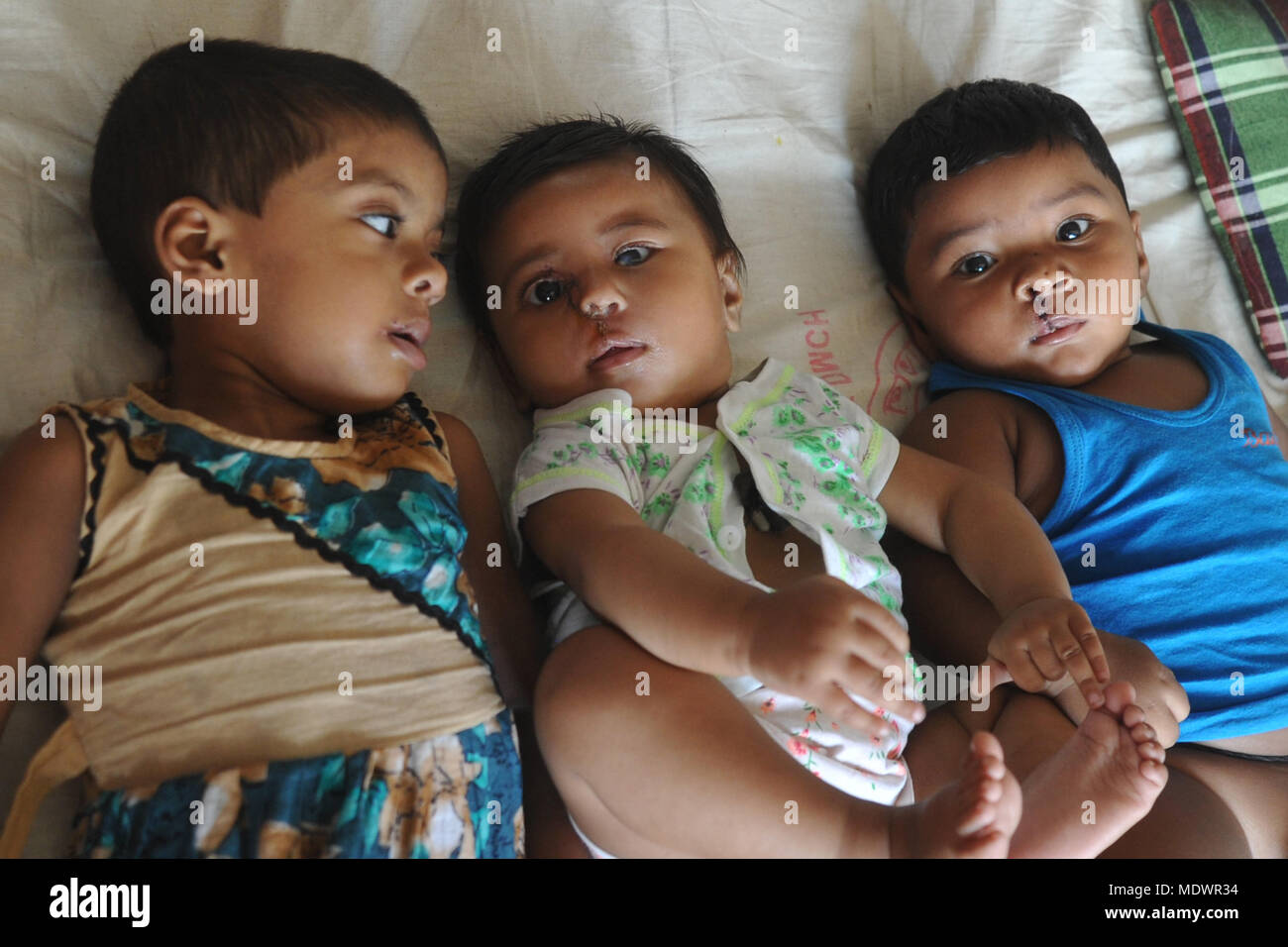 Birth defect baby boy with harelip in Dhaka medical college burn unit ...