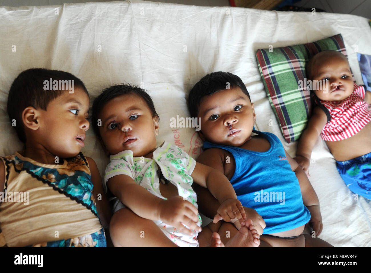 Birth defect baby boy with harelip in Dhaka medical college burn unit ...