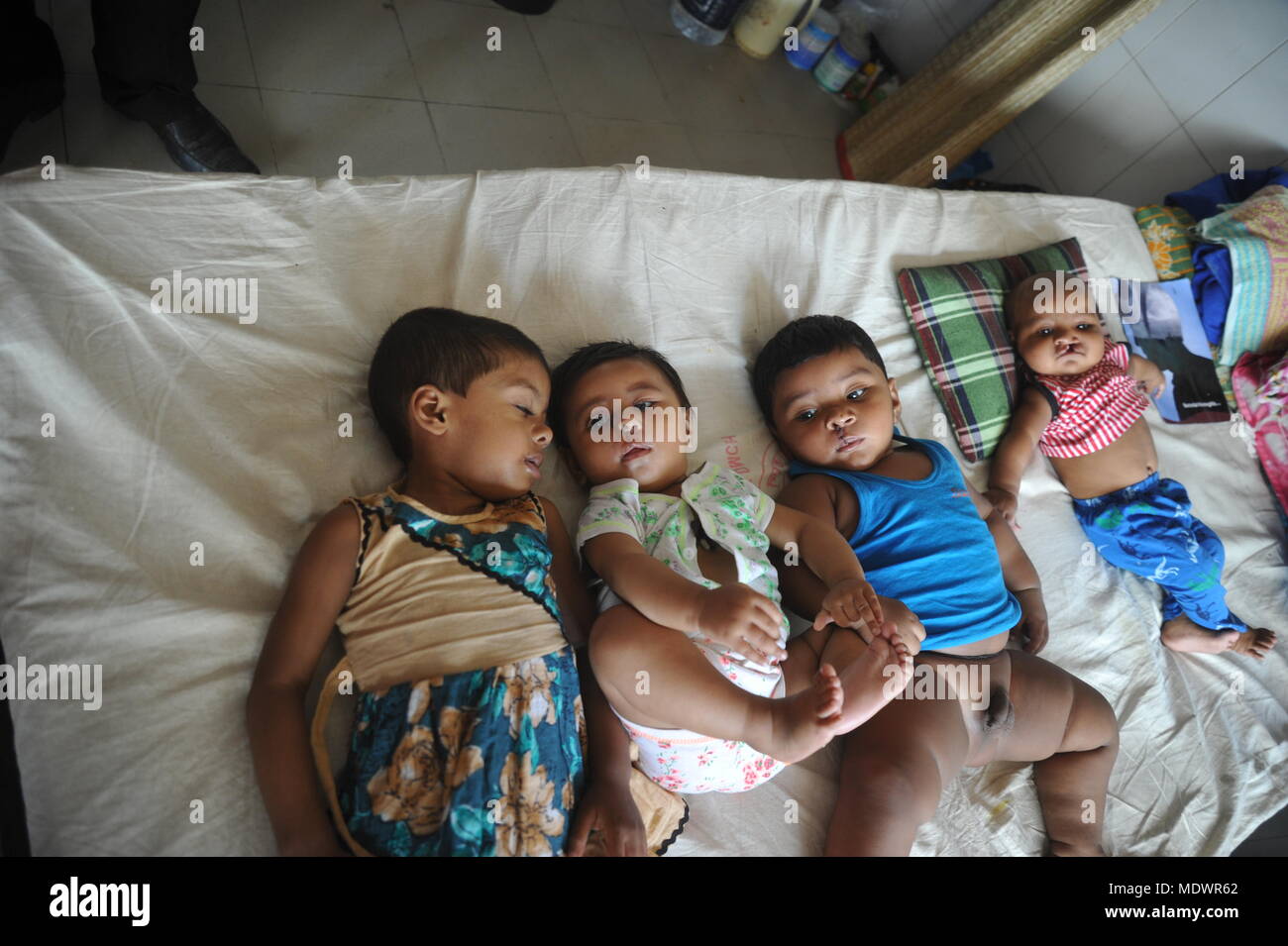 Birth defect baby boy with harelip in Dhaka medical college burn unit ...