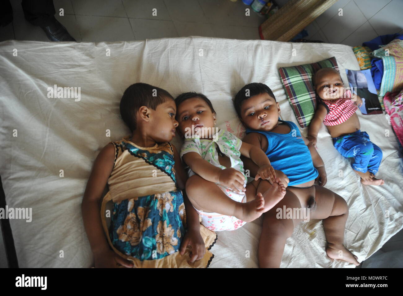 Birth defect baby boy with harelip in Dhaka medical college burn unit ...