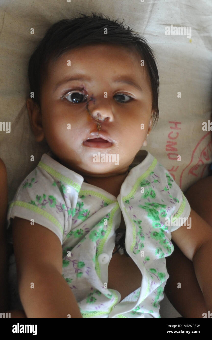 Birth defect baby boy with harelip in Dhaka medical college burn unit ...