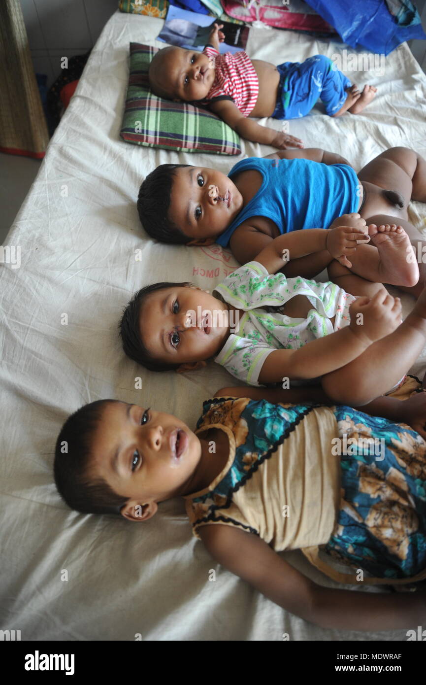 Birth defect baby boy with harelip in Dhaka medical college burn unit ...