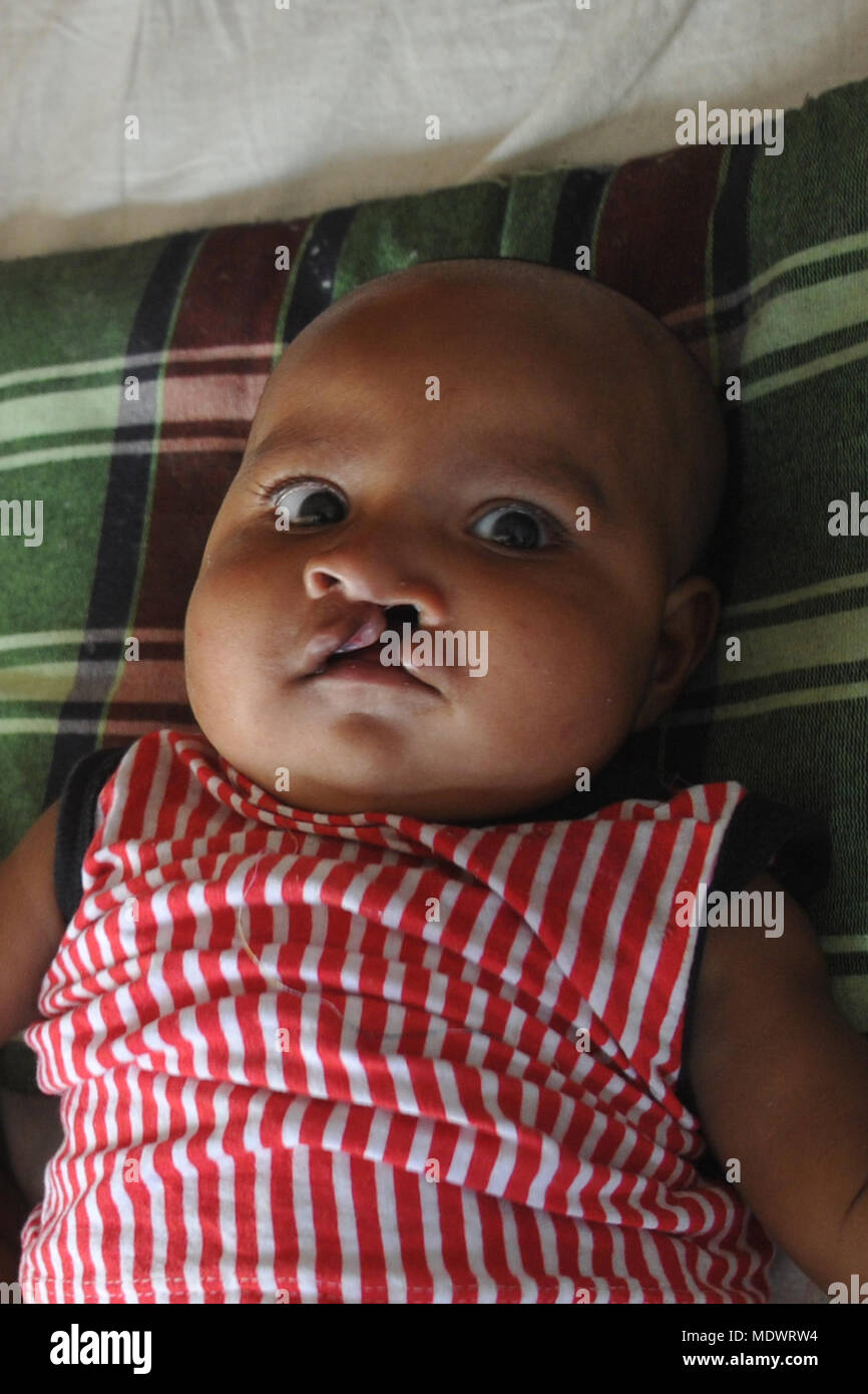 Birth defect baby boy with harelip in Dhaka medical college burn unit ...