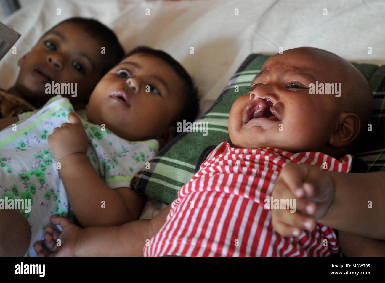 Birth defect baby boy with harelip in Dhaka medical college burn unit ...