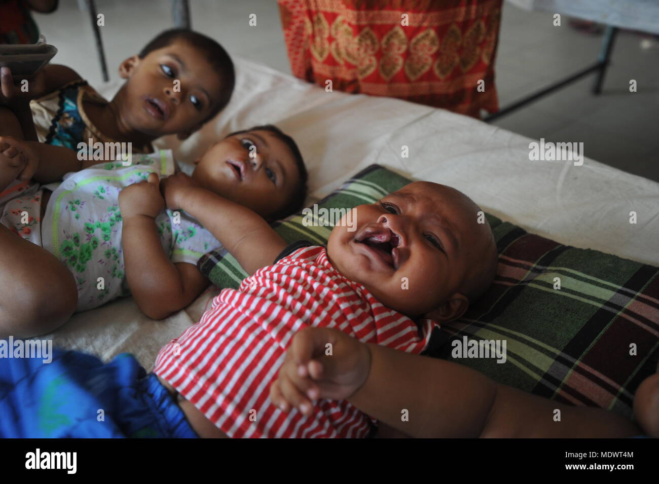 Birth defect baby boy with harelip in Dhaka medical college burn unit ...