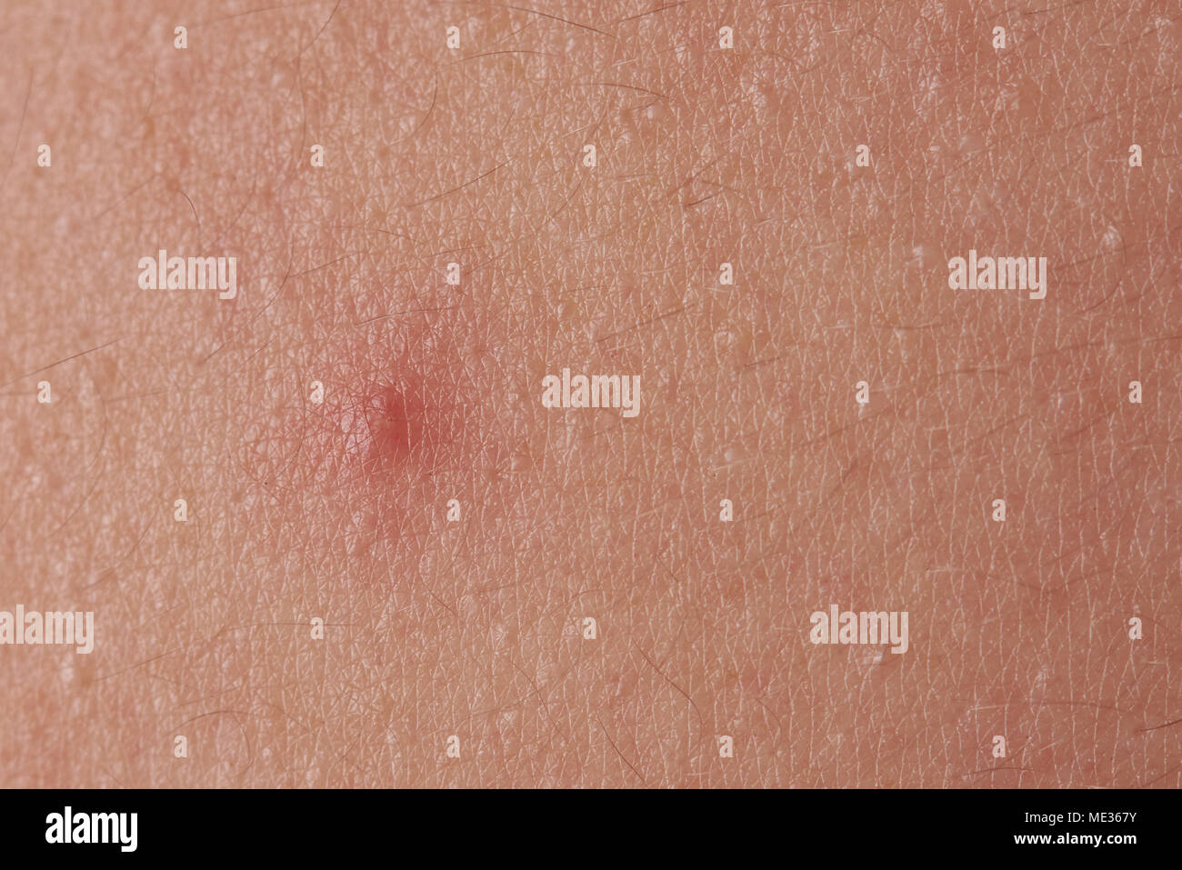 Red pimple on human skin macro close up Stock Photo - Alamy