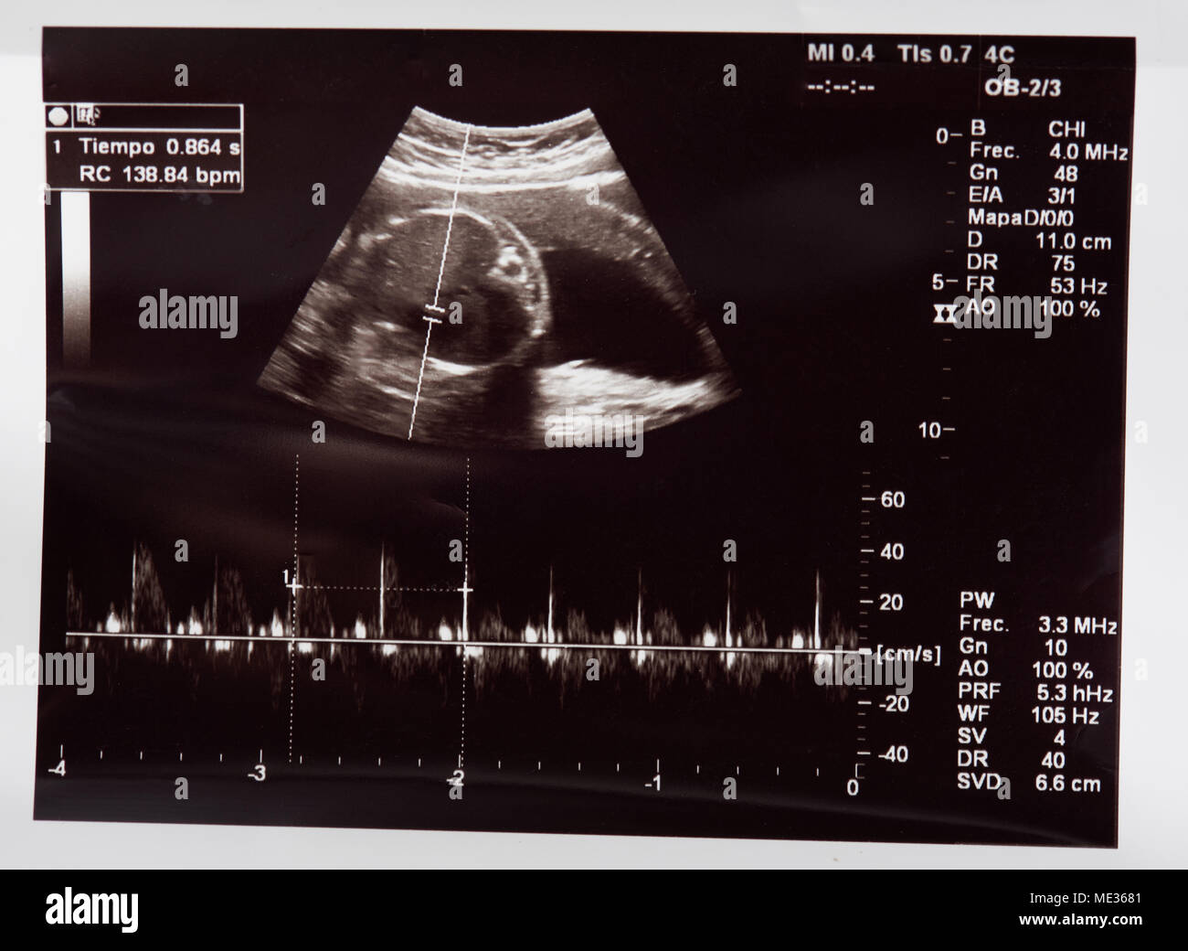 Ultrasound heart hi-res stock photography and images - Alamy