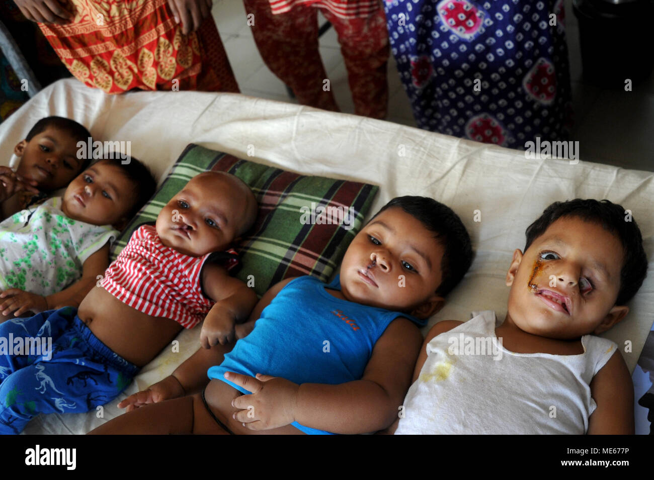 Birth defect baby boy with harelip in Dhaka medical college burn unit ...