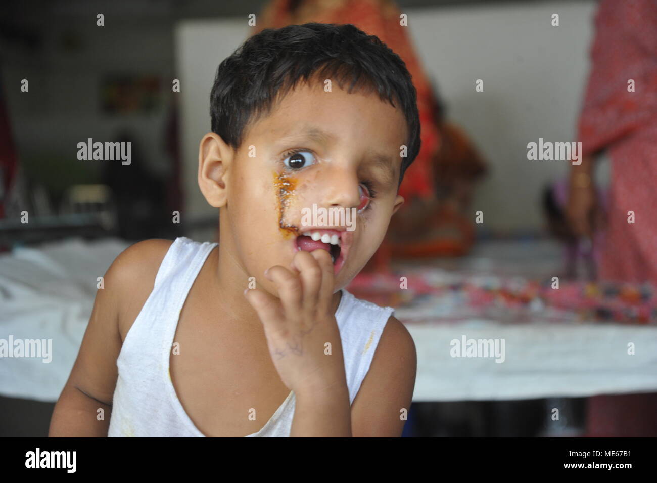Birth defect baby boy with harelip in Dhaka medical college burn unit ...