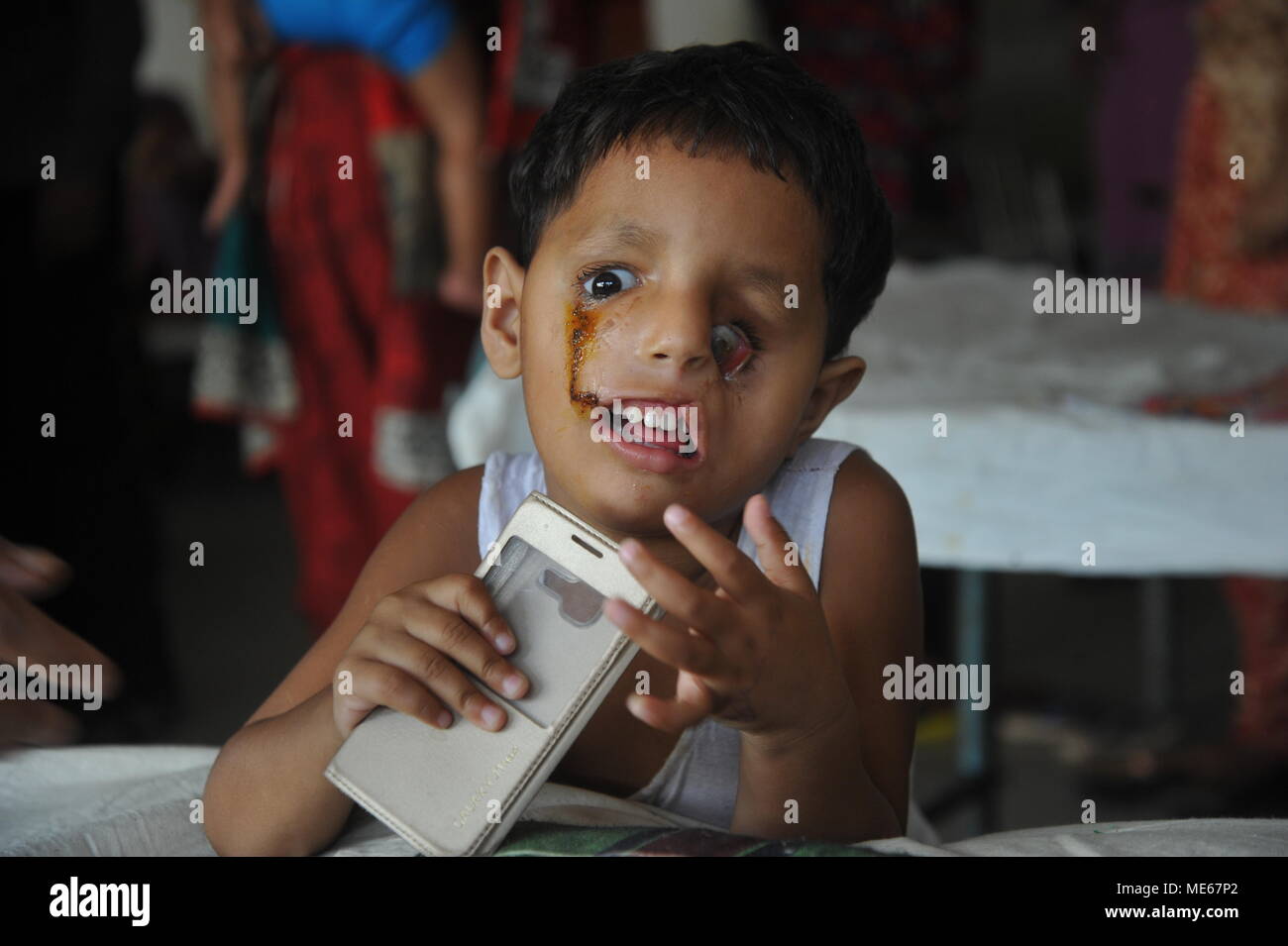Birth defect baby boy with harelip in Dhaka medical college burn unit ...