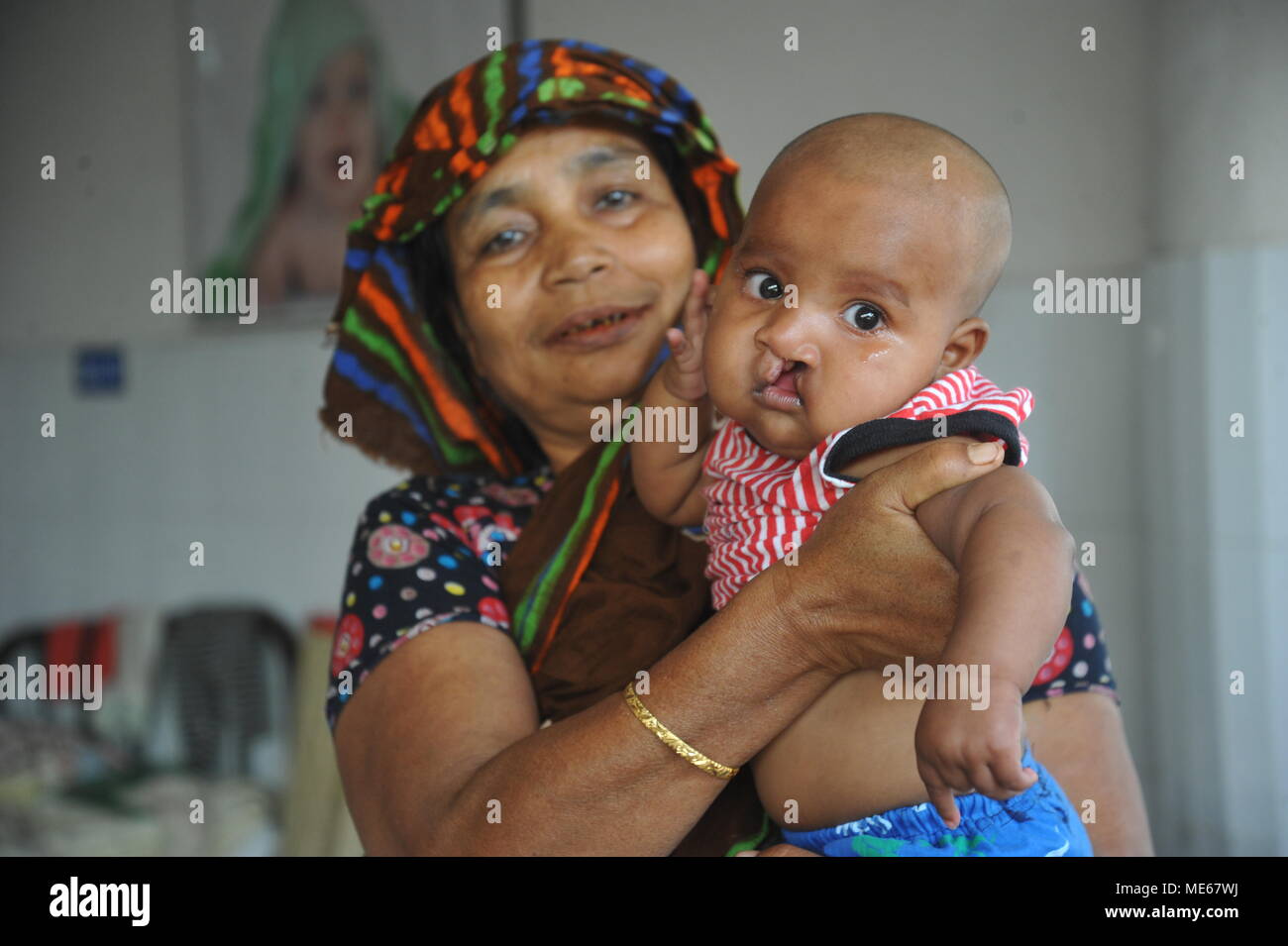 Birth defect baby boy with harelip in Dhaka medical college burn unit ...
