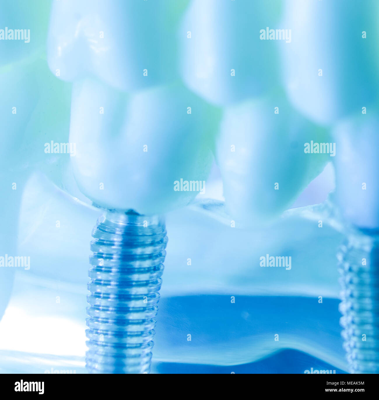 Dental titanium aesthetic orthodontic tooth implant in dentists mouth ...