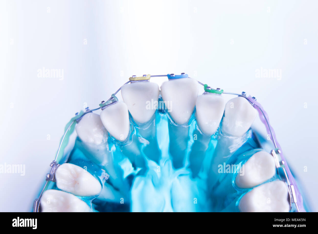 Dental teeth retainers metal aligners brackets to straighten teeth in ...