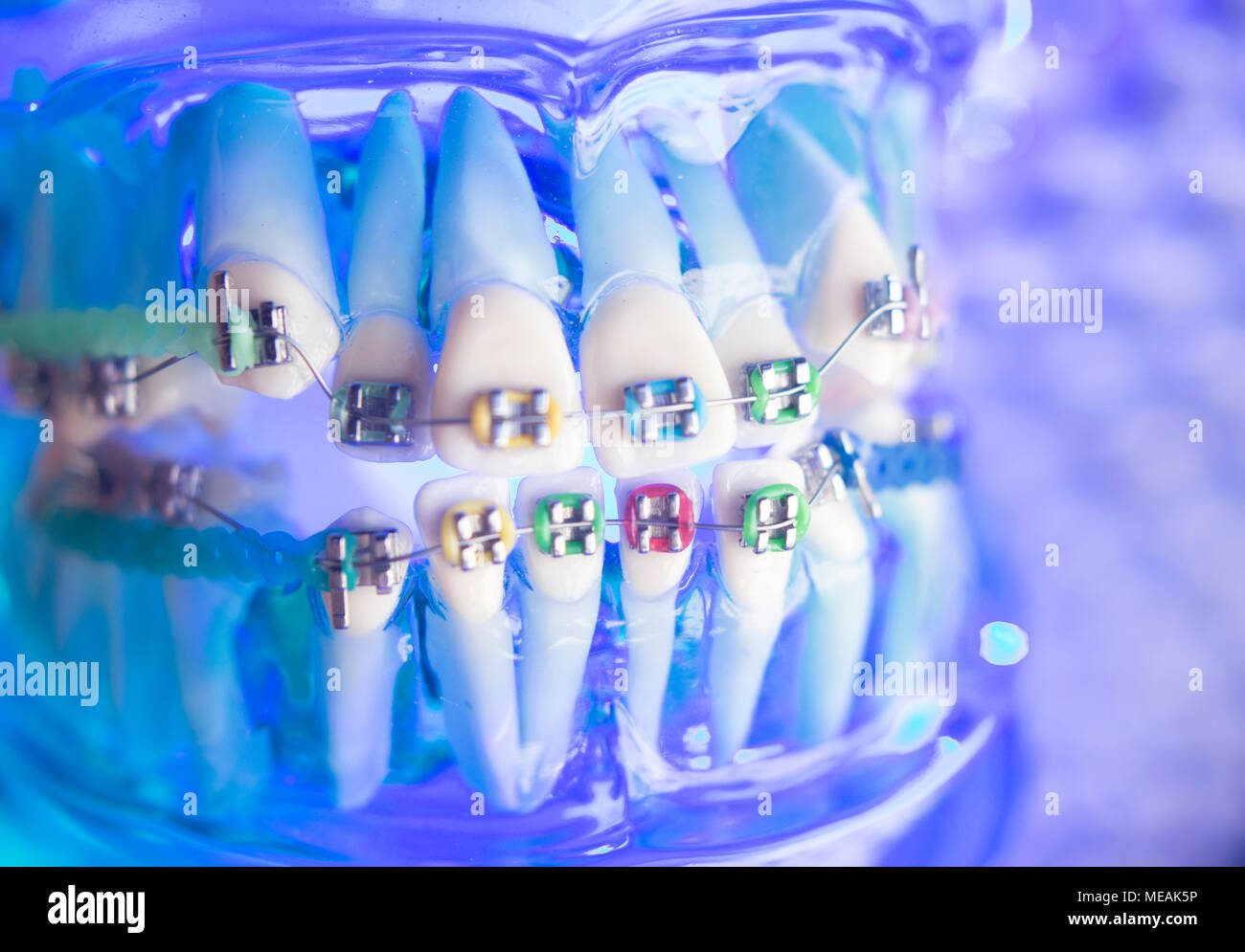 Dental teeth retainers metal aligners brackets to straighten teeth in ...